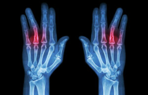 Jammed Fingers: What to Do and When to See a Doctor