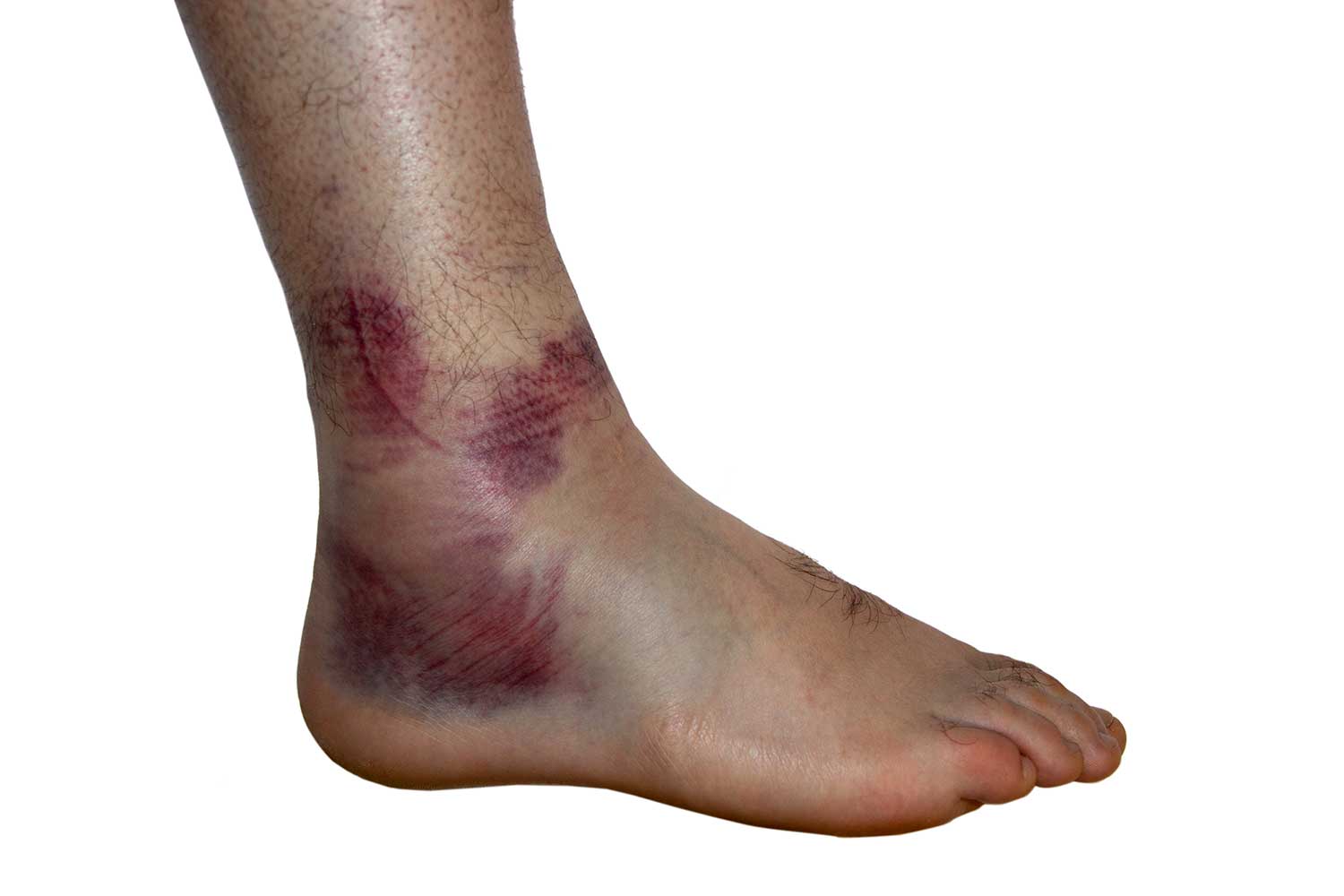 School Sports Injuries - RapidCare Emergency Room 24/7