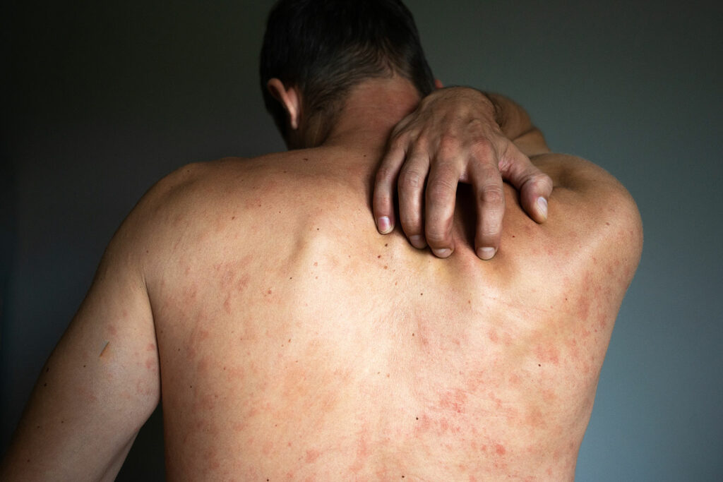 Skin Rashes Treatment Near You Texas - Safe, Fast & Open 24/7